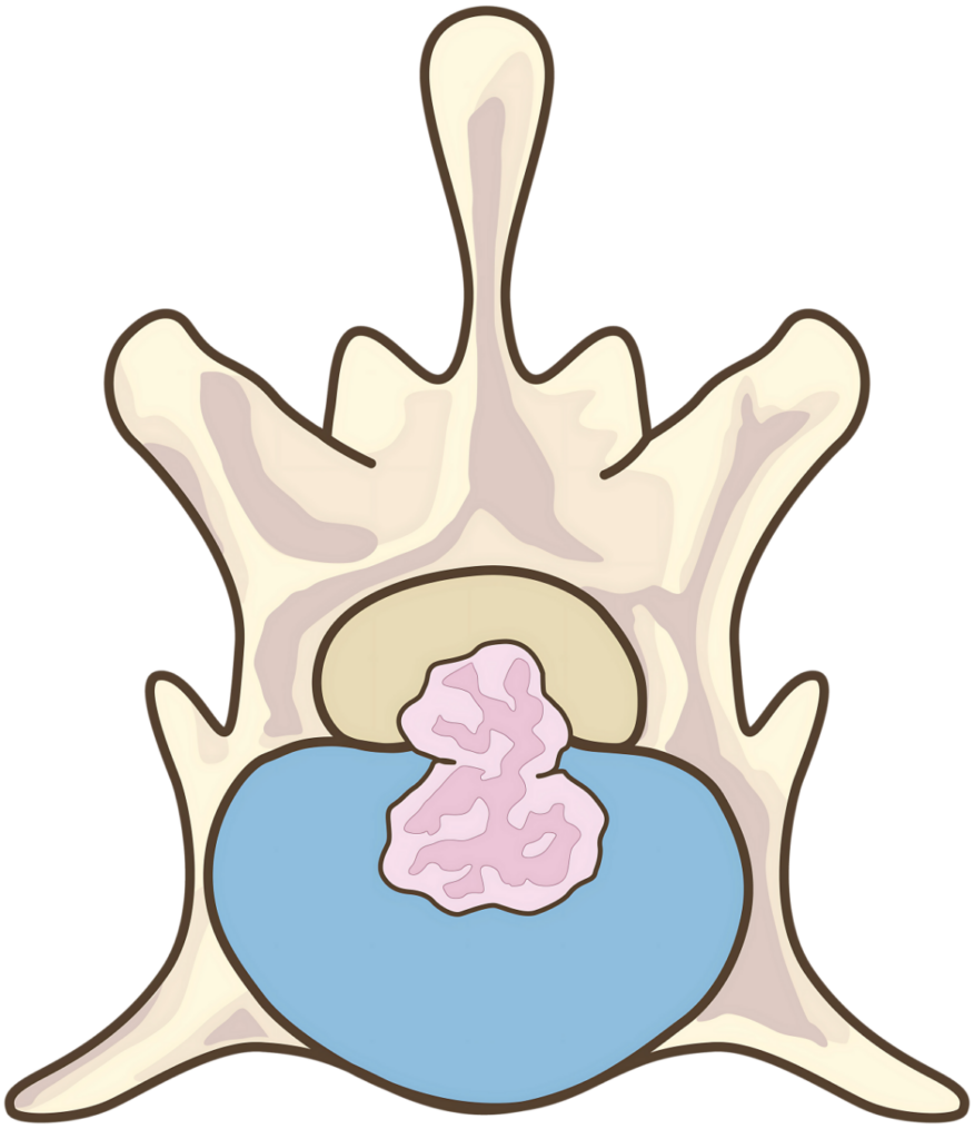 Intervertebral Disk Disease (IVDD)